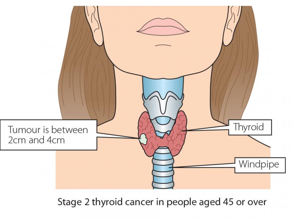 What Are The Grades And Stages Of Thyroid Cancer Irish Cancer Society