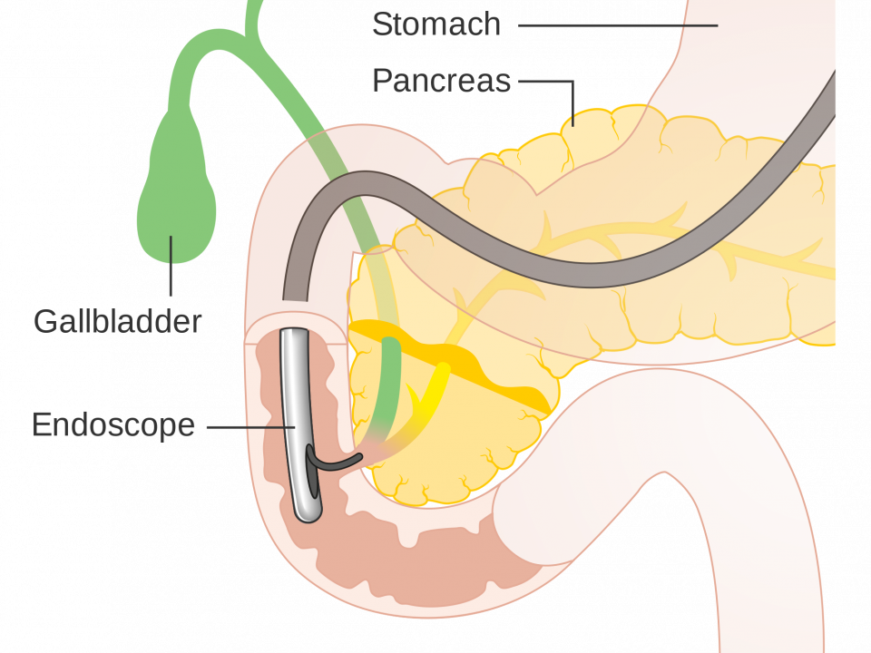 Endoscopic retrograde cholangiopancreatography (ERCP)